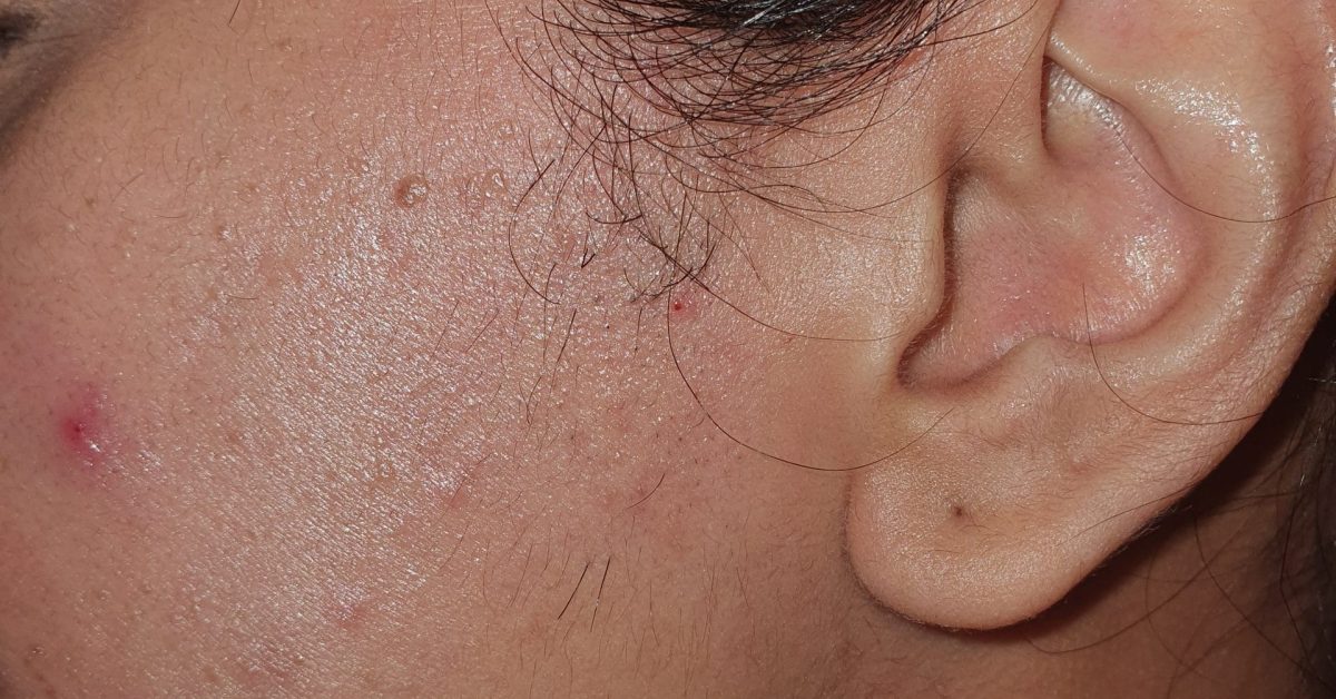 Does laser hair removal help people with PCOS?